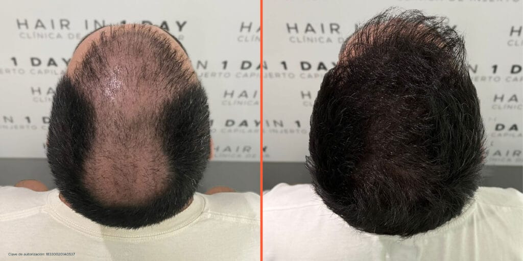 INJERTO DE CABELLO: ANTES Y DESPUÉS